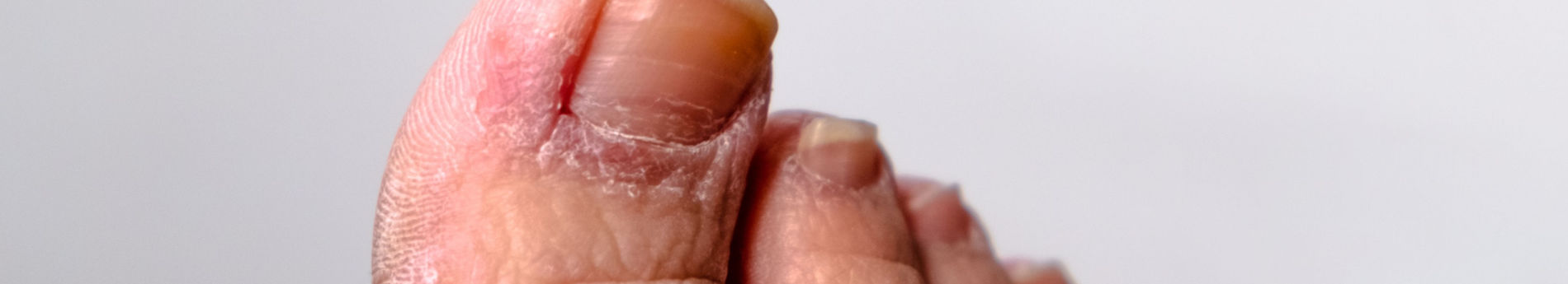 Pharmacie Parent SRL : Home > Mycoses des pieds