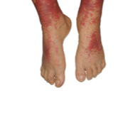 Pharmacie Parent SRL : Home > Santé A-Z - Problèmes de santé - Vascularites